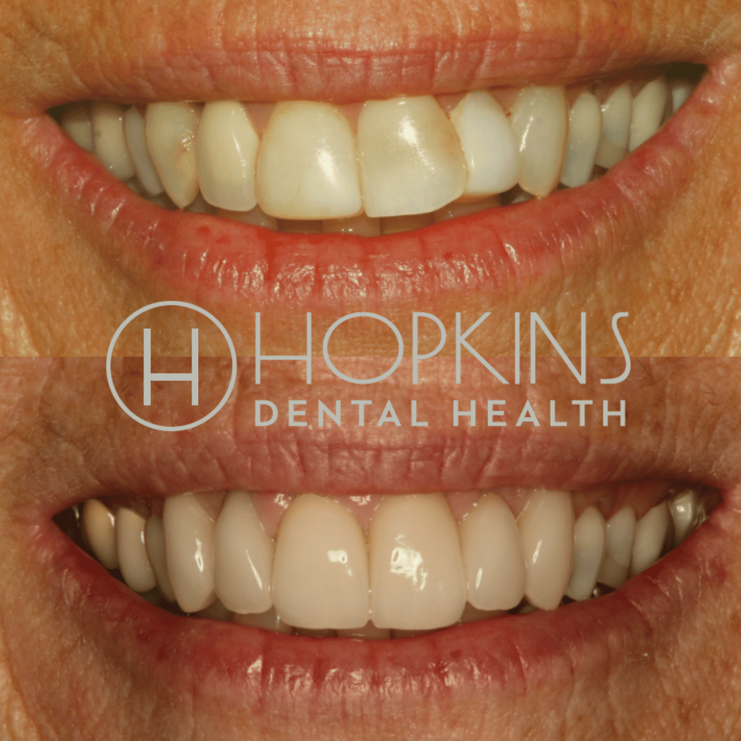 Smile Designs - Hopkins Dental Health